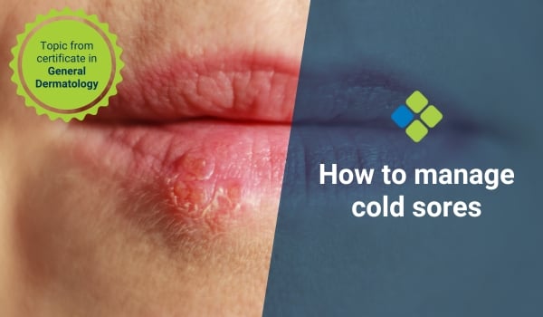 How to manage cold sores